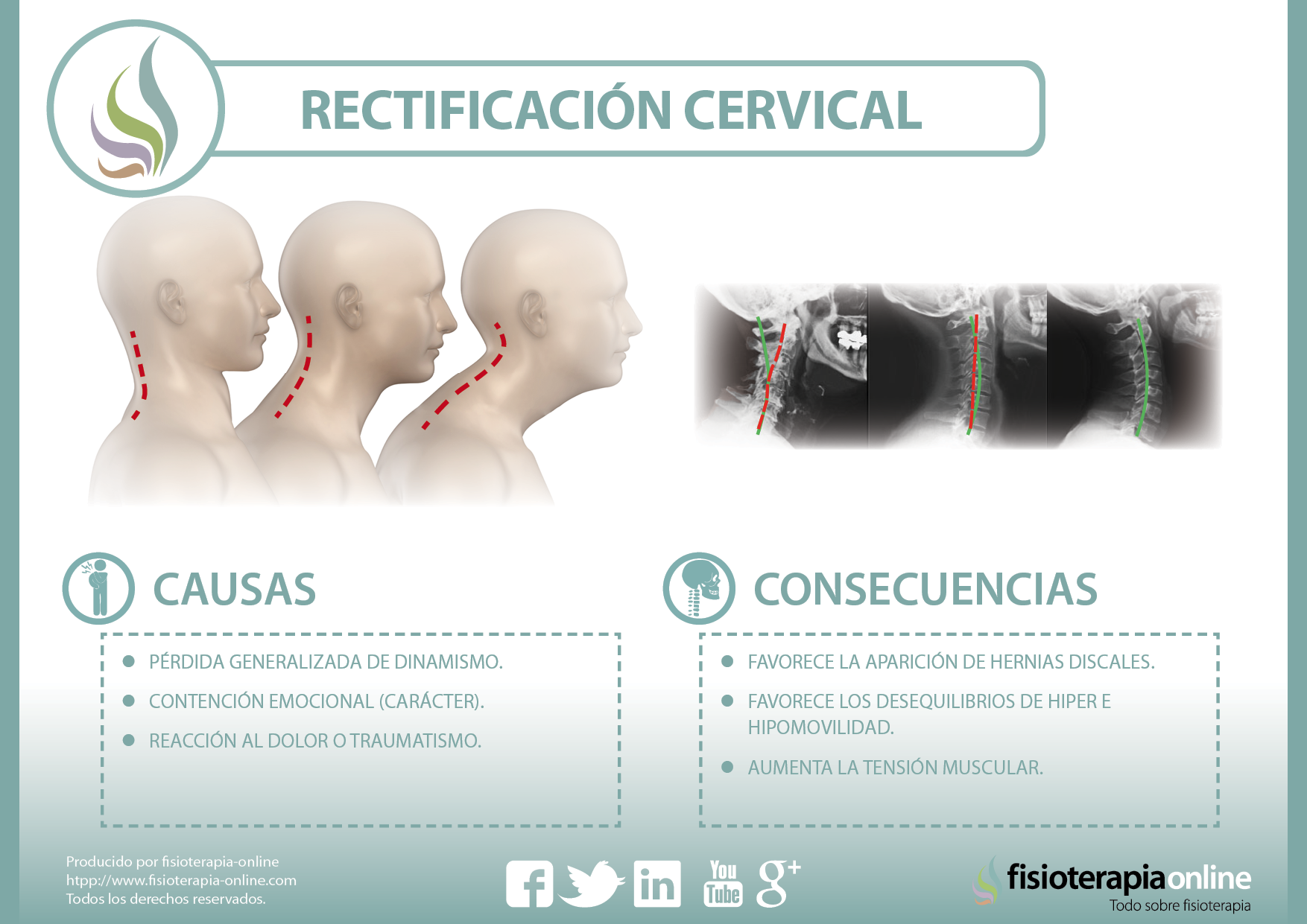 Baja laboral por rectificación cervical: ¿Qué debes saber ...