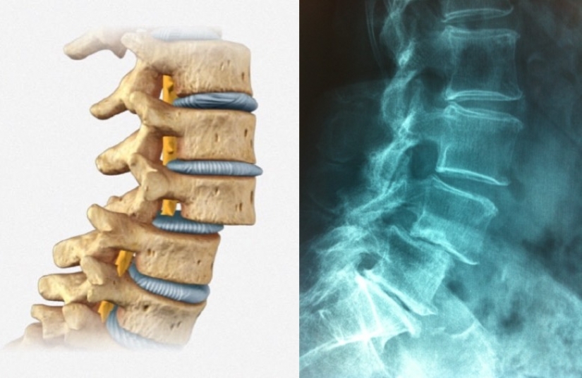 Discopatía lumbar L5 S1: causas, síntomas y tratamiento - CCFProsario.com